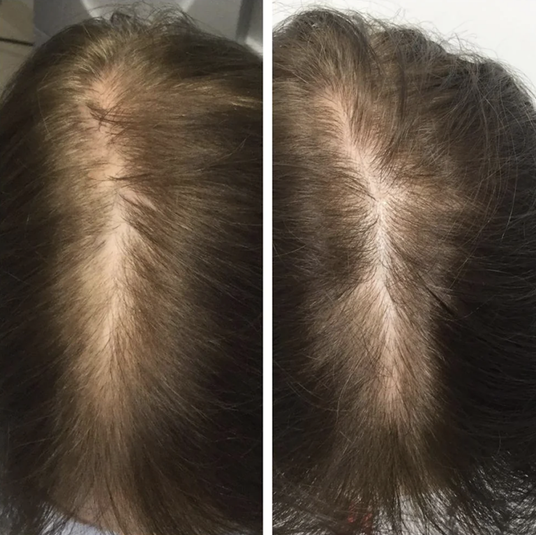 PRP Hair Treatment